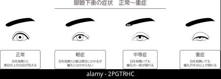 Medical Illustration, Ptosis Symptoms Normal to Severe - Translation ...