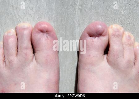 Ingrowing Toenails, Big Toes, Roots cut out Stock Photo - Alamy