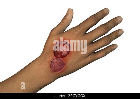 Buruli ulcer on a hand, illustration Stock Photo - Alamy