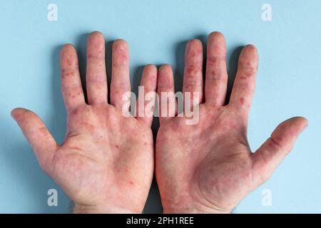 Painful rash, red spots blisters on hand. Close up Allergy rash, human ...