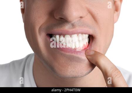 Man showing inflamed gums on white background, closeup Stock Photo - Alamy