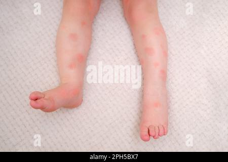 a baby boy with atopic dermatitis on his left cheek lying on a white ...