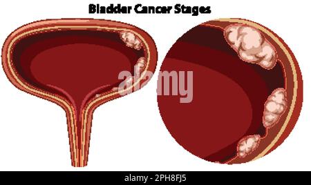 Bladder Cancer Stages Vector illustration Stock Vector Image & Art - Alamy