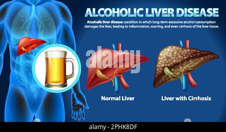 Informative poster of alcoholic liver disease Cirrhosis illustration ...