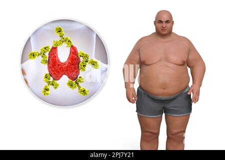 Autoimmune thyroid disease and obesity, illustration Stock Photo - Alamy