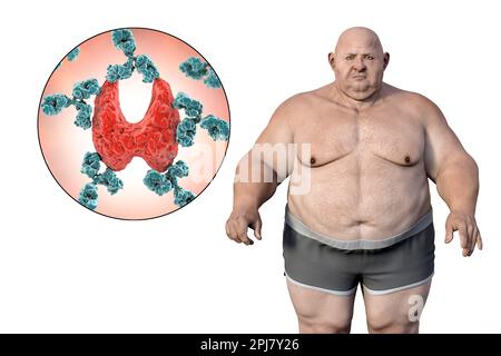 Autoimmune thyroid disease and obesity, illustration Stock Photo - Alamy