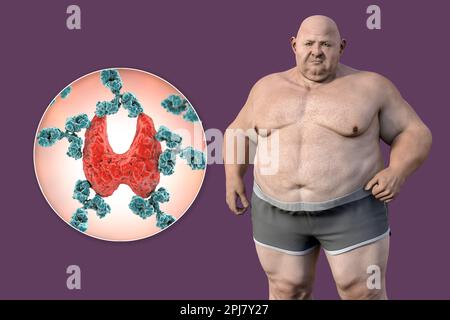 Autoimmune thyroid disease and obesity, illustration Stock Photo - Alamy