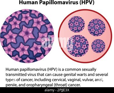 Human Papillomavirus with explanation illustration Stock Vector Image ...
