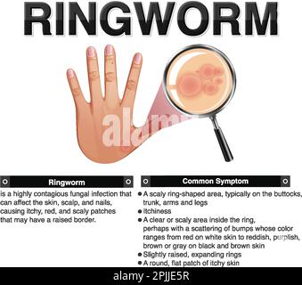 Informative symptoms of Ringworm illustration Stock Vector Image & Art ...