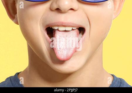 Oral candidiasis or thrush (white patches) in the mouth of a 77-year ...