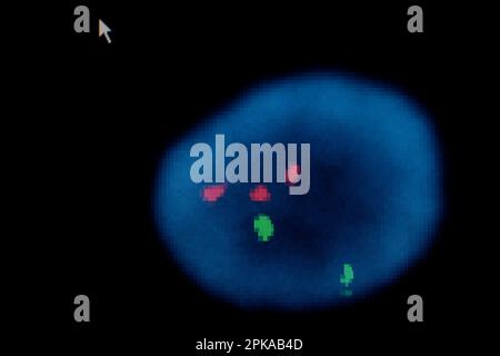 Fetal medicine: amniocentesis and study of the karyotype Stock Photo ...