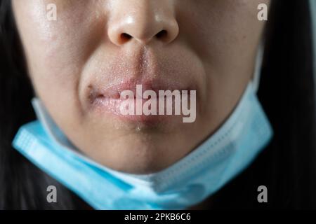 Skin irritation due to wearing a mask Stock Photo - Alamy