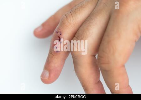 Stitched wound on a finger. Hand with stitched cut wound Stock Photo ...