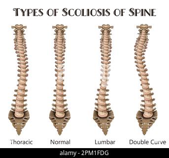 Medical poster demonstrating types of scoliosis on white background ...