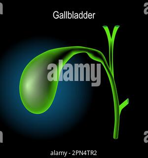 Gallstones. Cholelithiasis. Cholecystitis. Inflammation of the ...
