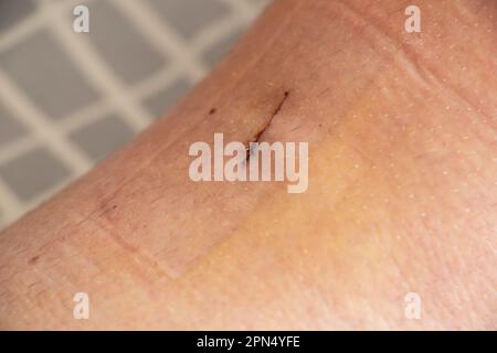 Stitched up skin after an operation on sick patient after performing a ...