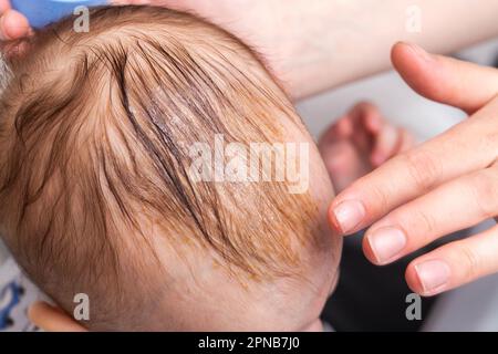 Smearing a seborrheic crust with baby oil on a child's head. Combing ...