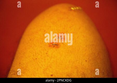 Surgical staple closing incision after Unicompartmental arthroplasty ...