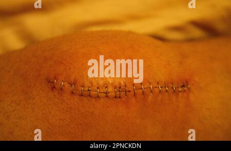 Surgical staple closing incision after Unicompartmental arthroplasty ...