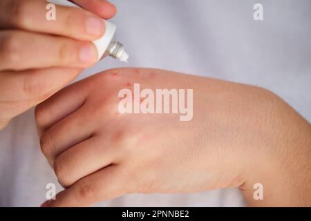 Woman applying white medical corticosteroid ointment on eczema on her ...