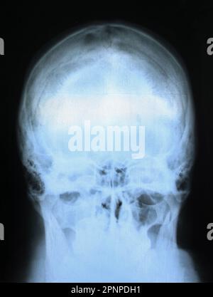 Headache of trauma. Film x-ray human skull . front view Stock Photo - Alamy