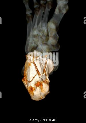 CT Scan ankle joint with 3d rendering of calcaneus bone showing ...