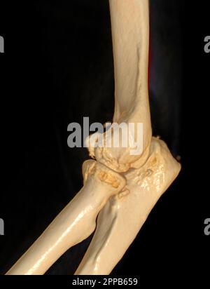 CT scan of elbow joint 3d rendering Stock Photo - Alamy