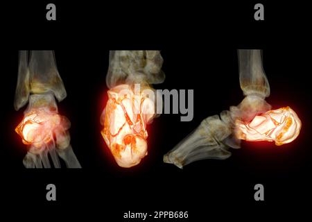 CT Scan ankle joint with 3d rendering of calcaneus bone showing ...