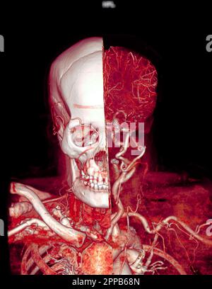 CTA brain and carotid artery or CT angiography of the brain 3D ...
