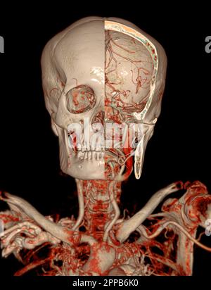 CTA brain and carotid artery or CT angiography of the brain 3D ...