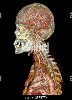 CTA brain and carotid artery or CT angiography of the brain 3D ...