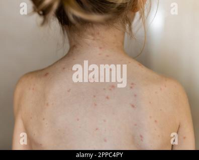 Chickenpox rash. Close-up of a rash on the chest of a 5-year-old male ...
