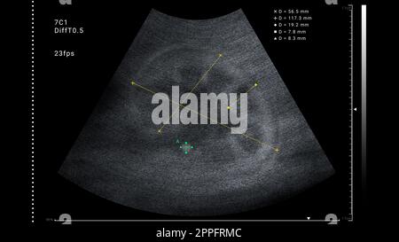 Sonogram of human kidney, illustration. Ultrasound diagnostic Stock ...