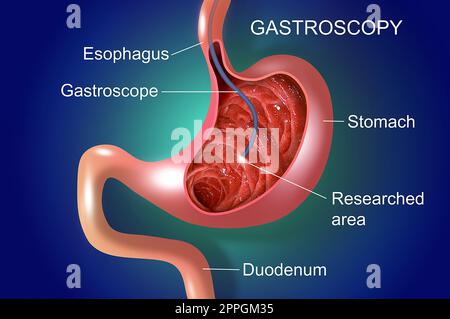 Digestive endoscopy or gastroscopy. Performing a gastroscopy procedure ...