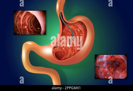 Digestive endoscopy or gastroscopy. Performing a gastroscopy procedure ...