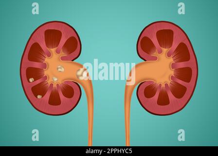 Illustration of healthy and diseased kidneys on blue background Stock ...