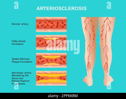 Human legs. Artery with blood cells desease. Concept of dry skin, old ...