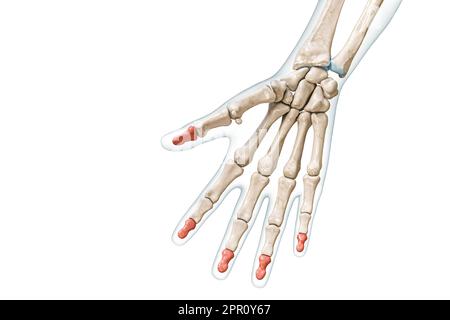 Illustration of the bones hand. This right hand palmar view labelled ...
