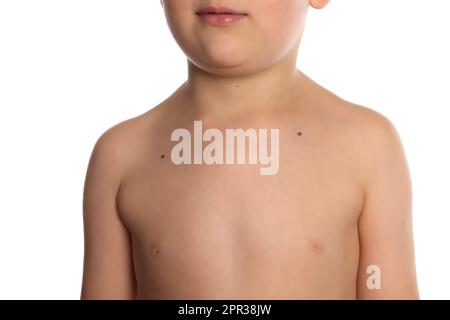 Closeup of boy's body with birthmarks on white background, back view ...