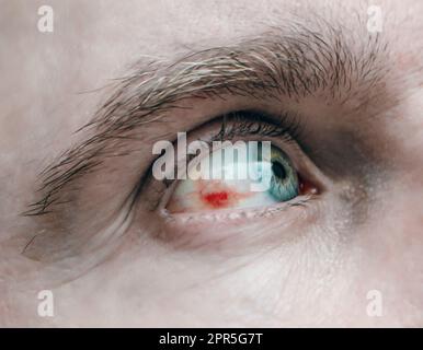 Ee of a man with a bursting vessel in the eyeball. Hemorrhage in the ...