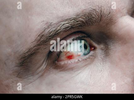 Ee of a man with a bursting vessel in the eyeball. Hemorrhage in the ...