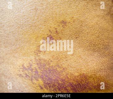 Bruise on the buttock skin injury from accident at home Stock Photo - Alamy
