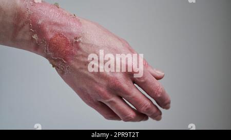 Close-up of a woman's hand with a burst blister from a boiled water ...