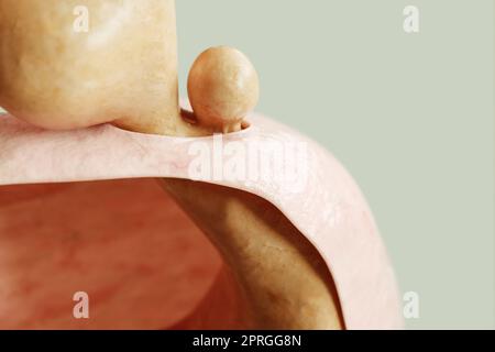 Mixed form of hiatus hernia type 3 - 3D rendering Stock Photo - Alamy