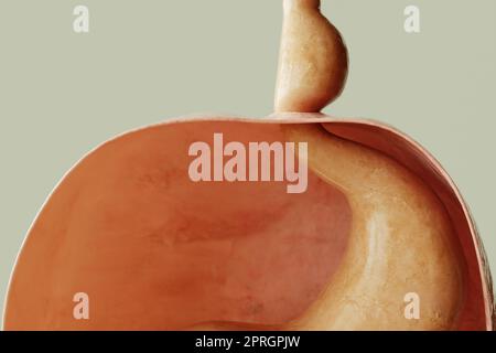 Axial hiatus hernia type 1 - entrance to the stomach via the diaphragm ...