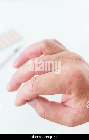 A man shows a reddening rash on his hands. The causes of itchy skin can ...
