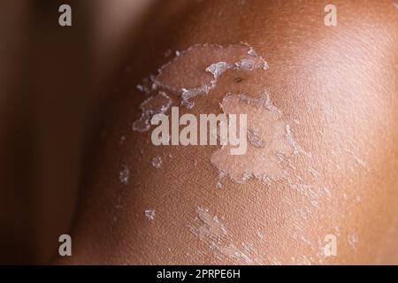 Male sunburned skin close up Stock Photo - Alamy