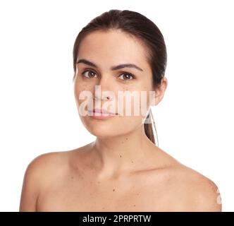 Woman with birthmarks on white background, back view Stock Photo - Alamy