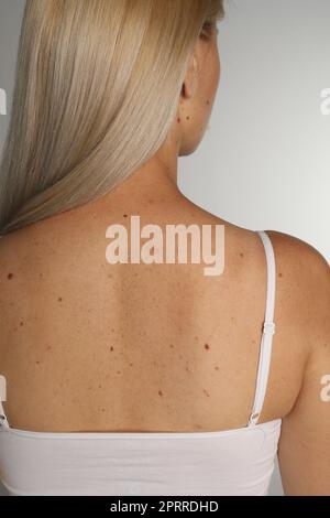 Woman with birthmarks on light grey background, back view Stock Photo ...