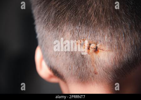 The lacerated suture wound of head which suture by nylion suture about ...